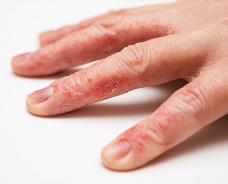 Eczema - Dermatitis | Wellington Dermatology