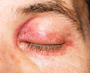 Patch Test for Allergy | Wellington Dermatology