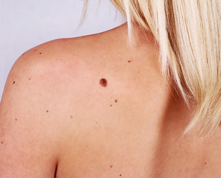 Skin Check / Mole Check | Wellington Dermatology